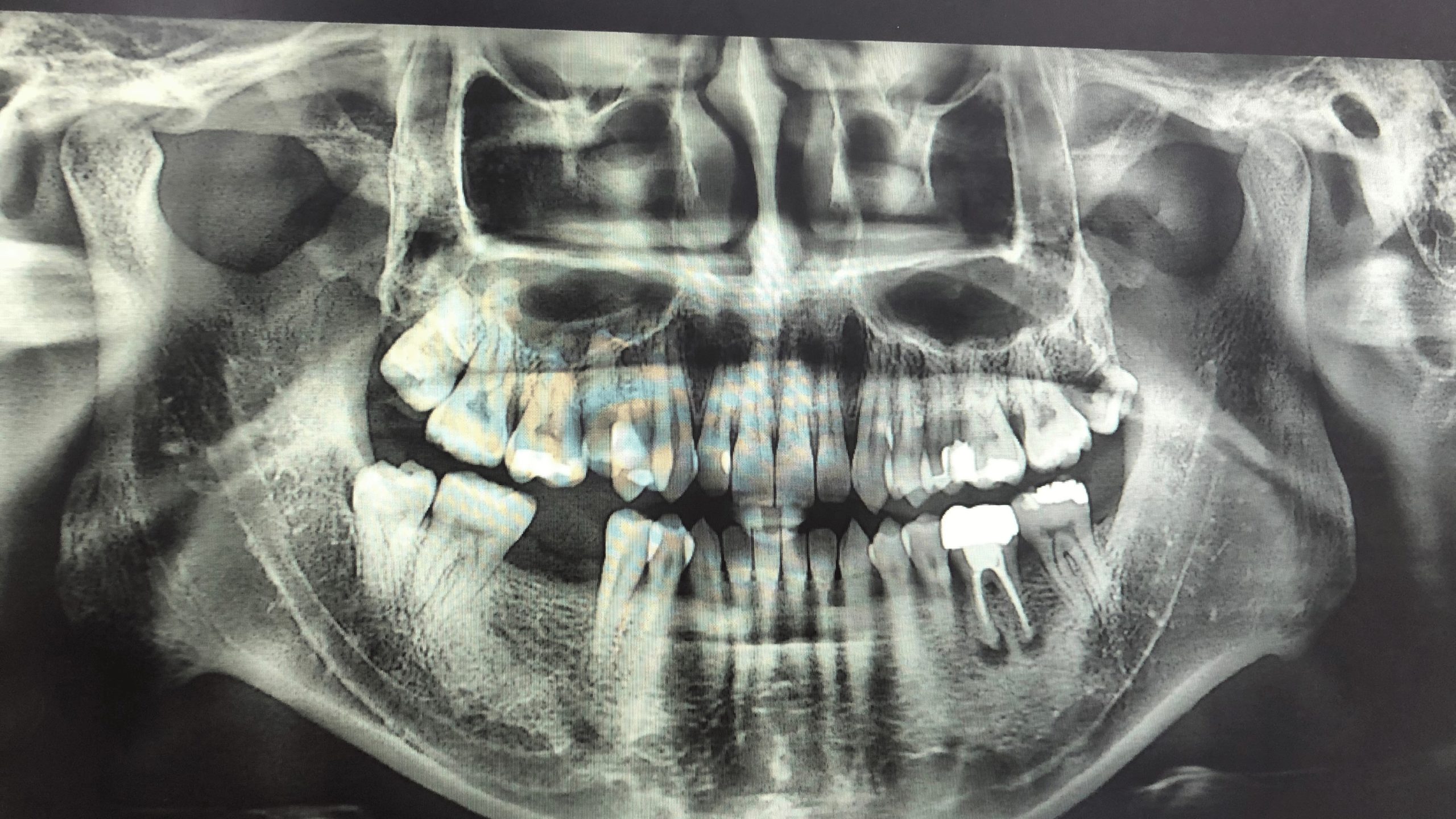 Jak często można wykonywać pantomogram?