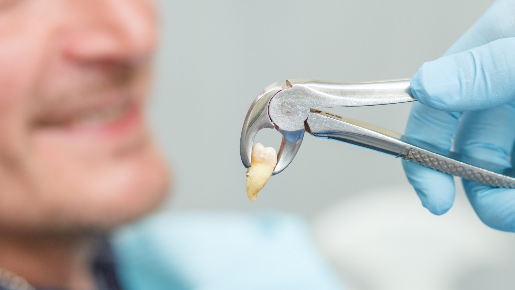 Skrzep po wyrwaniu zęba - czym jest i jak wygląda?